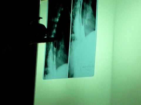 ESTUDIO NORMAL DE ESOFAGO 8 (esofagograma por doble contraste) - YouTube