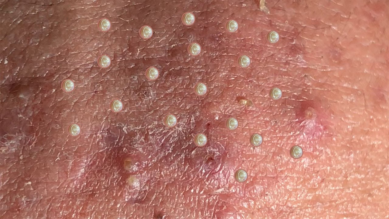 AWESOME BLACKHEADS POPPING | Suri Job 149 - YouTube