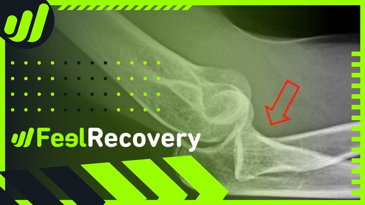 🟢 LUXACIÓN DE CODO - Causas, Síntomas y Tratamiento - YouTube