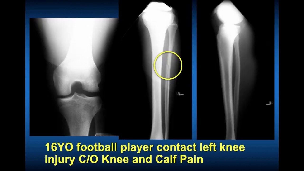 729 Acute MCL and ACL Contact Injury 02 - YouTube