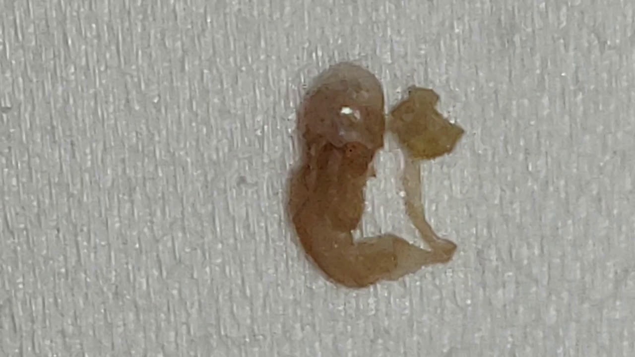 Morgellons, Parasites WTH!!! - YouTube