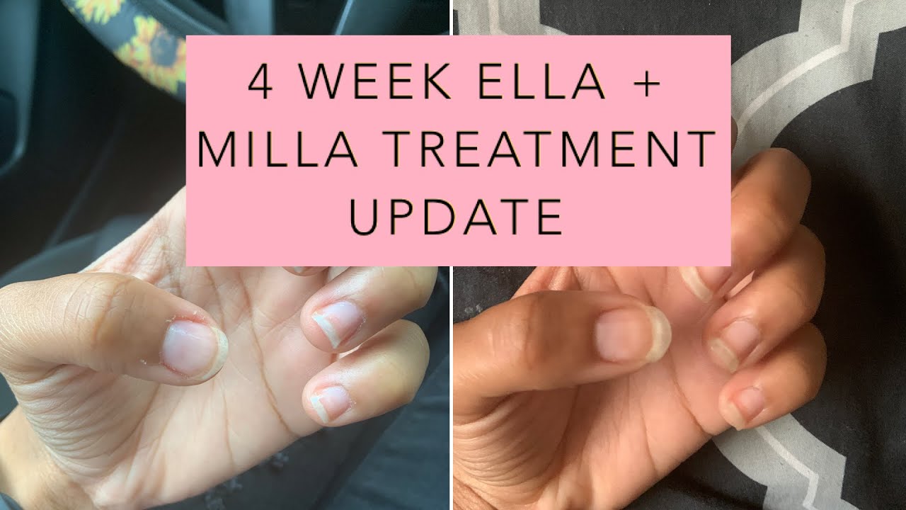 AMAZING😱 RESULTS FROM ELLA + MILLA FIRST AID NAIL KISS 💗 - YouTube