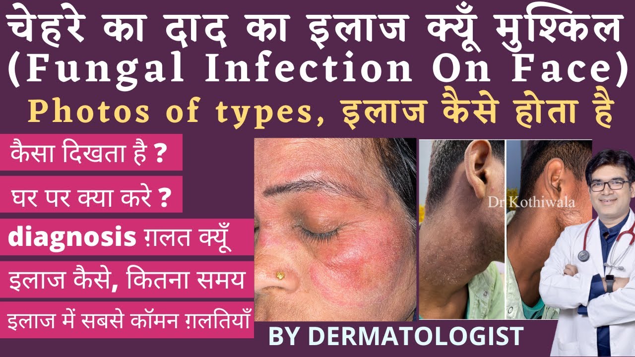 चेहरे के दाद का इलाज | Treatment of Fungal Infection On Face | 5 ...