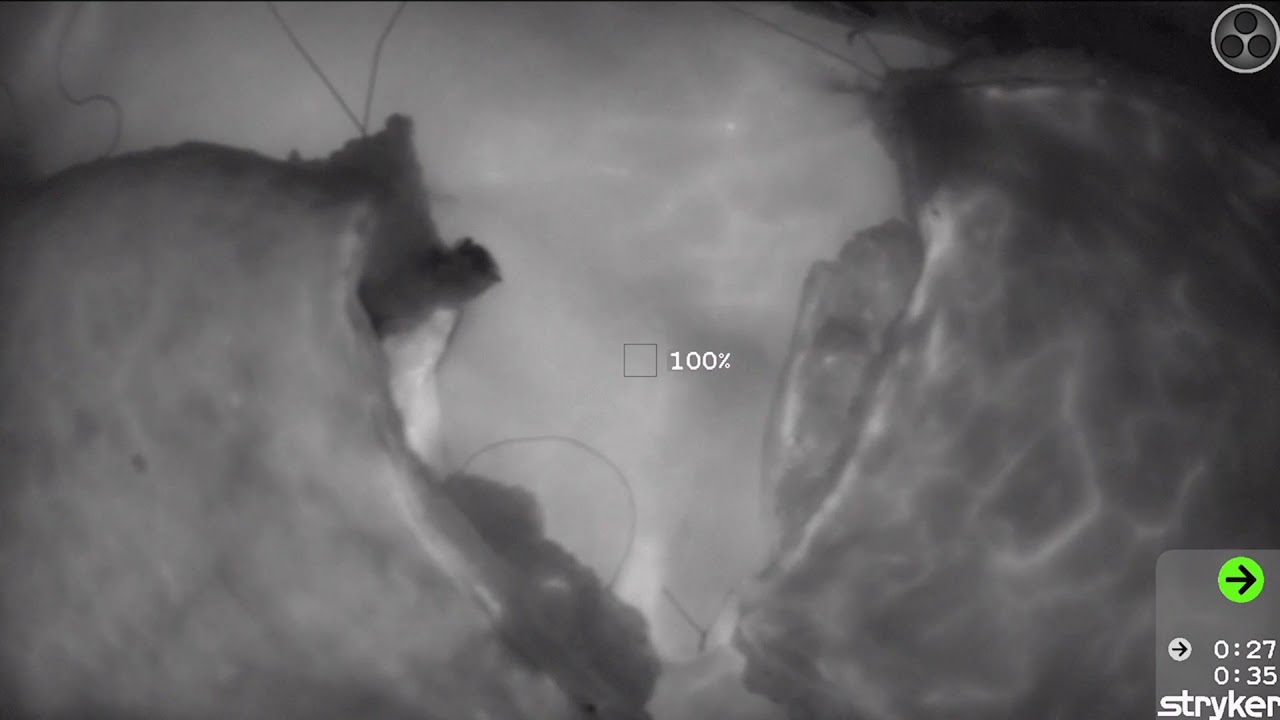 SPY PHI and SPY QP - DIEP Flap - YouTube