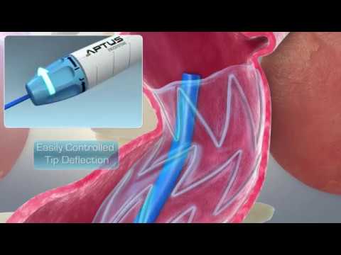 Endovascular Staple Video - Heli FX Endoanchors - YouTube