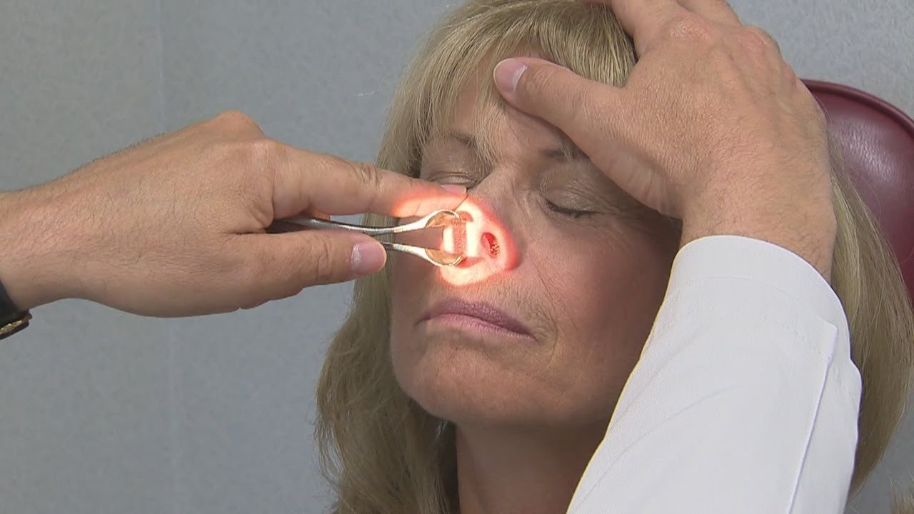 Using balloons to help sinus sufferers - YouTube