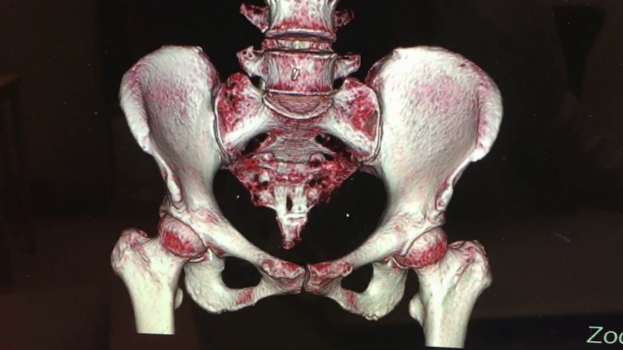 3DCTによる骨盤骨（寛骨、恥骨、坐骨）の位置関係 - YouTube