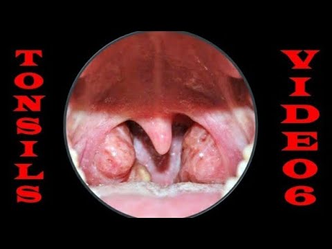 Intracapsular tonsillectomy (tonsillotomy) technique: Cost benefit ...