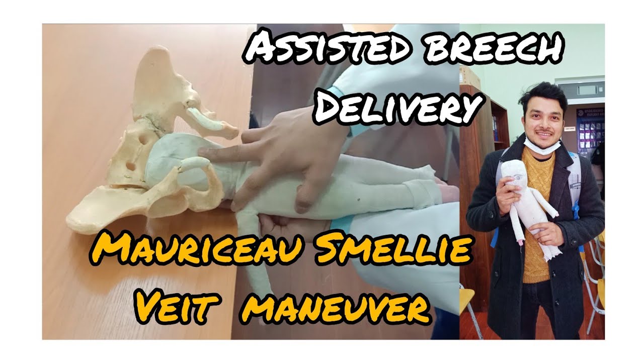 Mauriceau Smellie veit maneuver,Assisted breech delivery | aquiqur ...