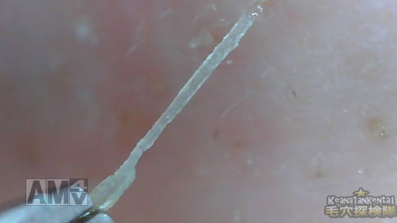 #01 Very Stretched Blackheads Close up - Blackheads Removal - YouTube