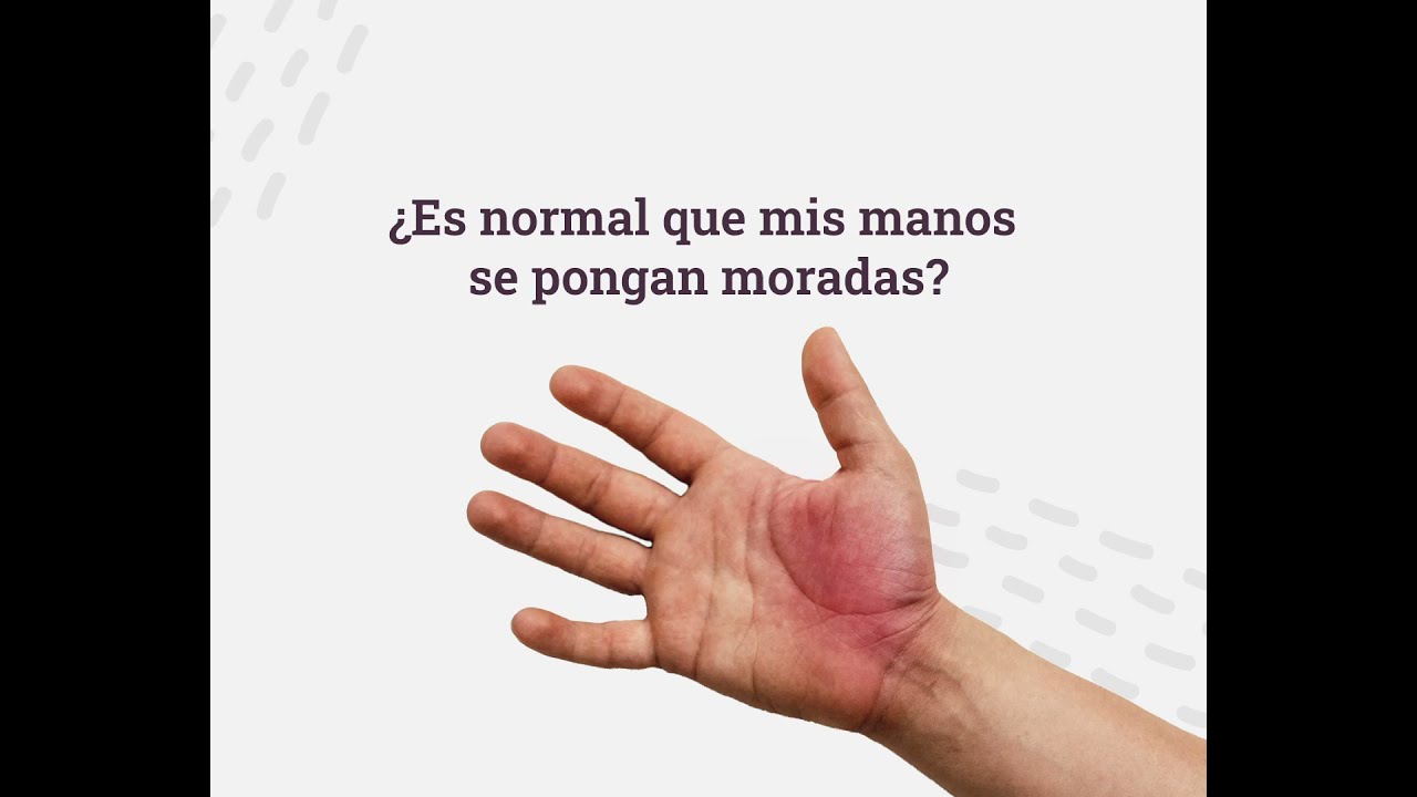 ¿Es normal que mis manos se pongan moradas?- Aclarando dudas. - YouTube