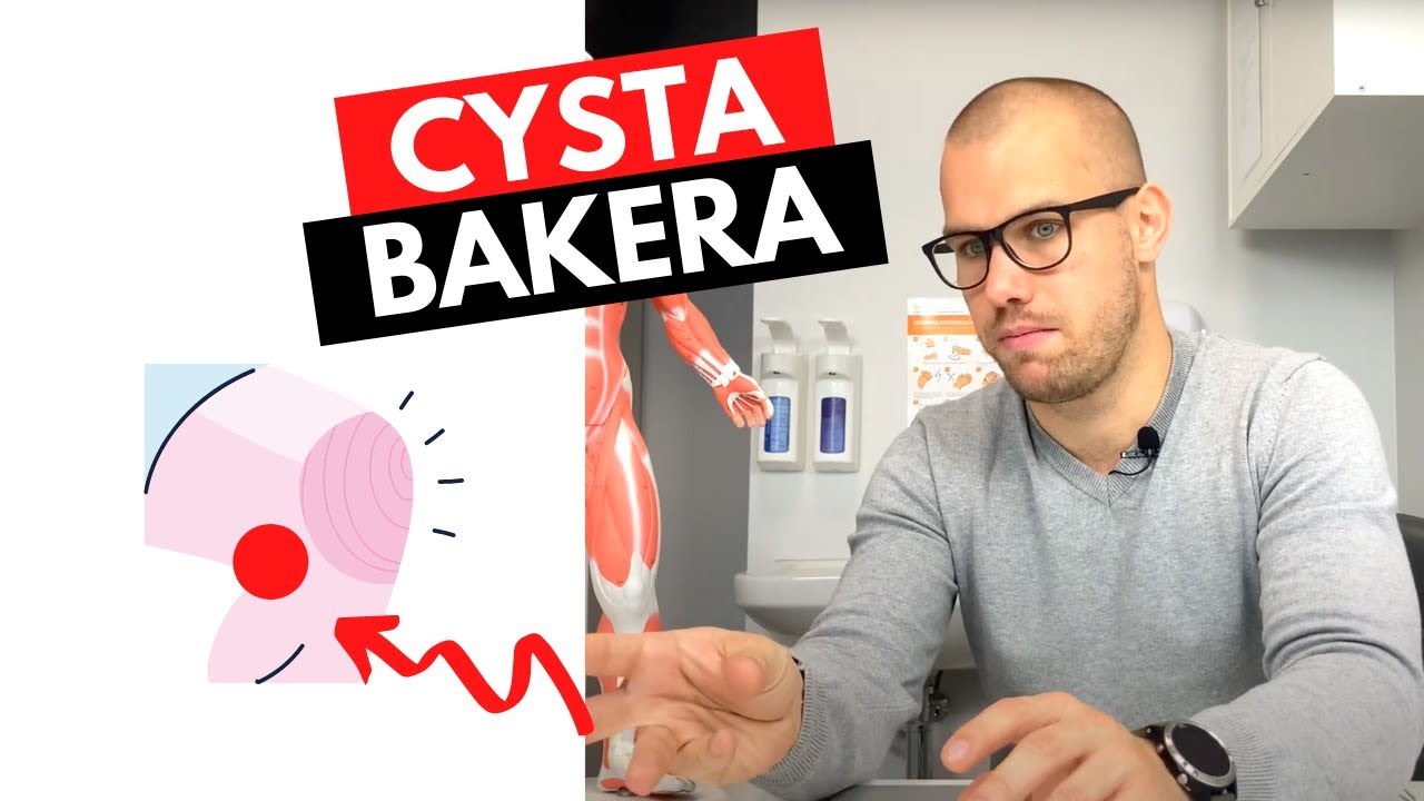 Cysta Bakera - Czy warto się nią przejmować ? - YouTube