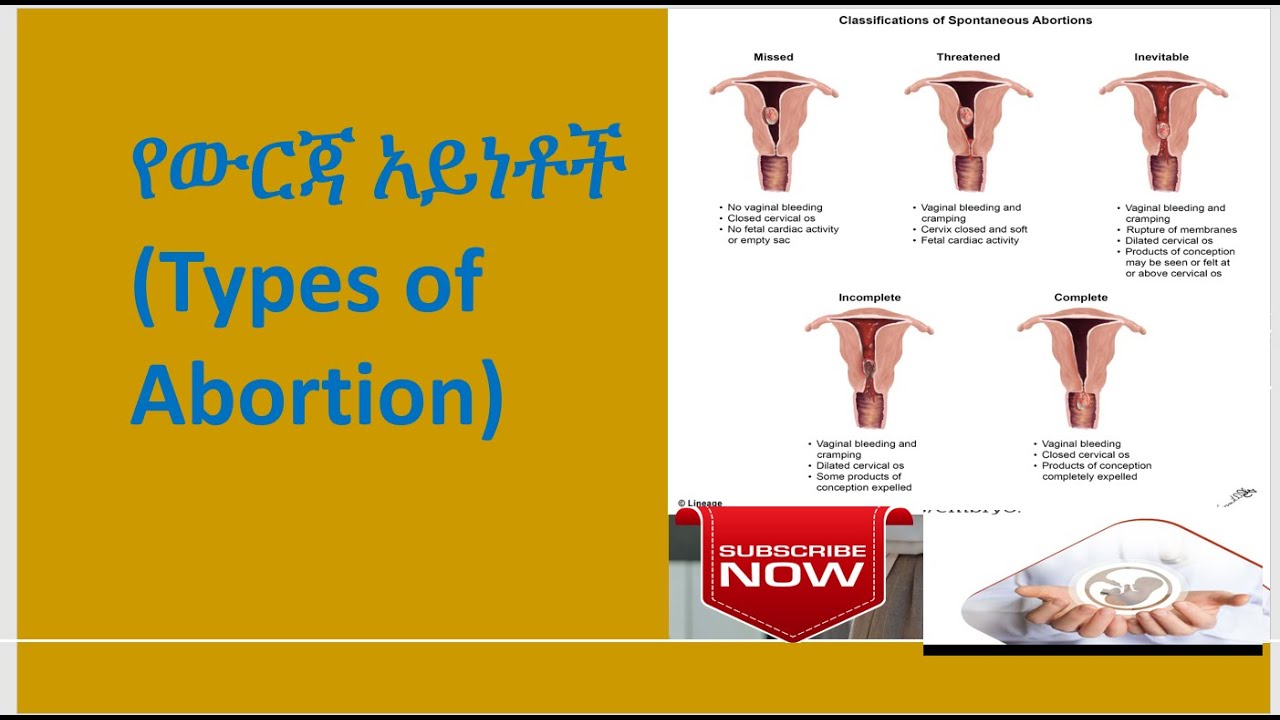 የውርጃ አይነቶች (Types of Abortion) - YouTube