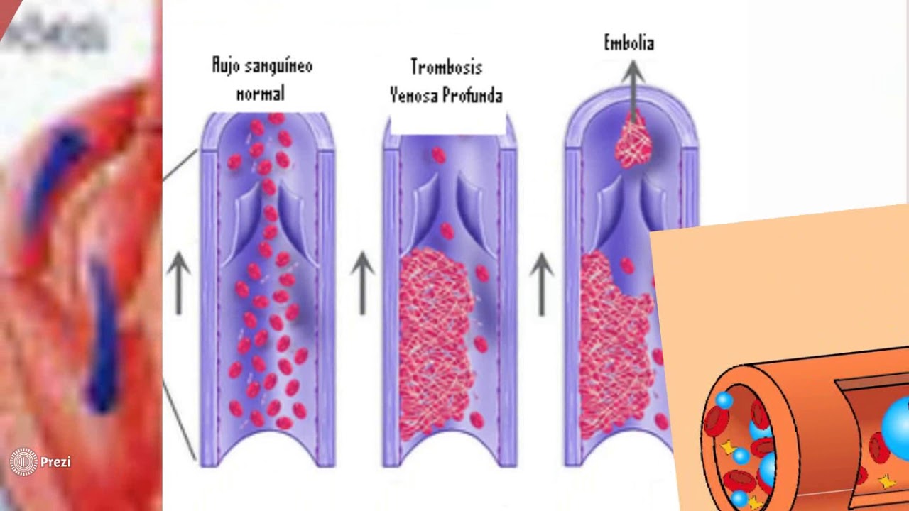 TROMBOEMBOLO - YouTube
