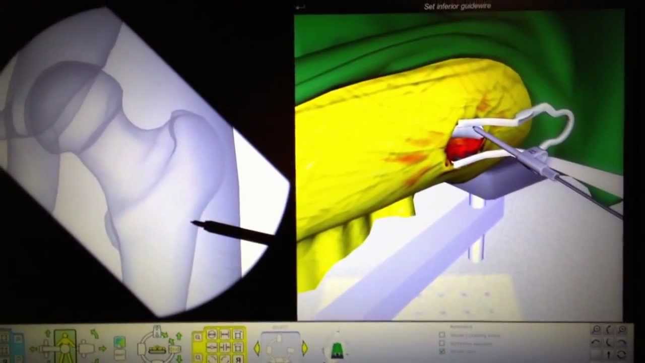 Advancments in biplane surgery - YouTube