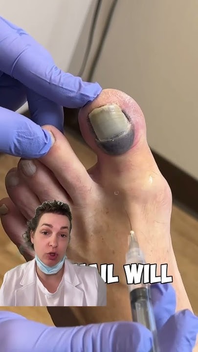 Zeh betäuben 😨 - YouTube