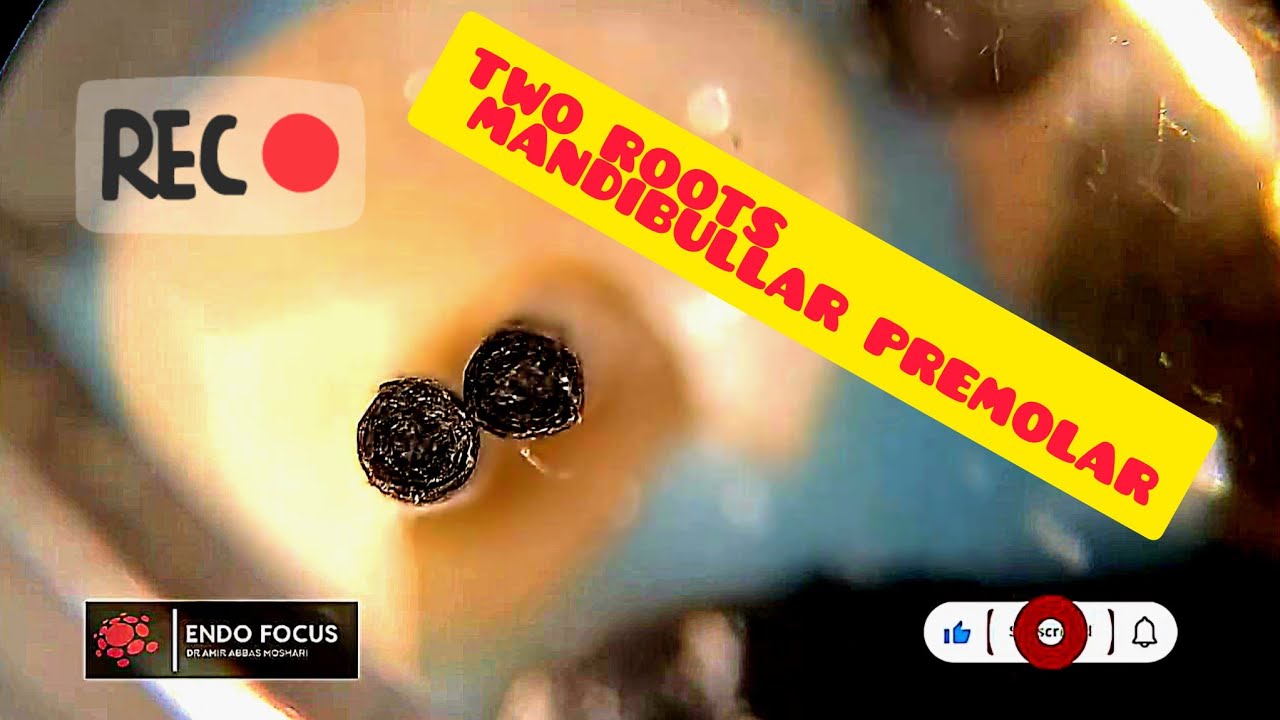 Unlocking The Mystery: Mandibular Premolar With Double Root Canals ...