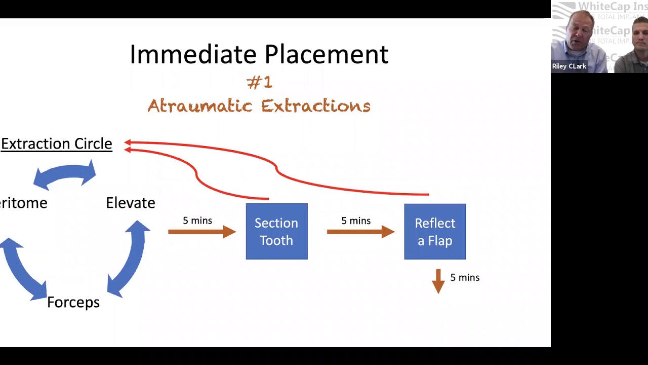Immediate Placement and Immediate Load - YouTube
