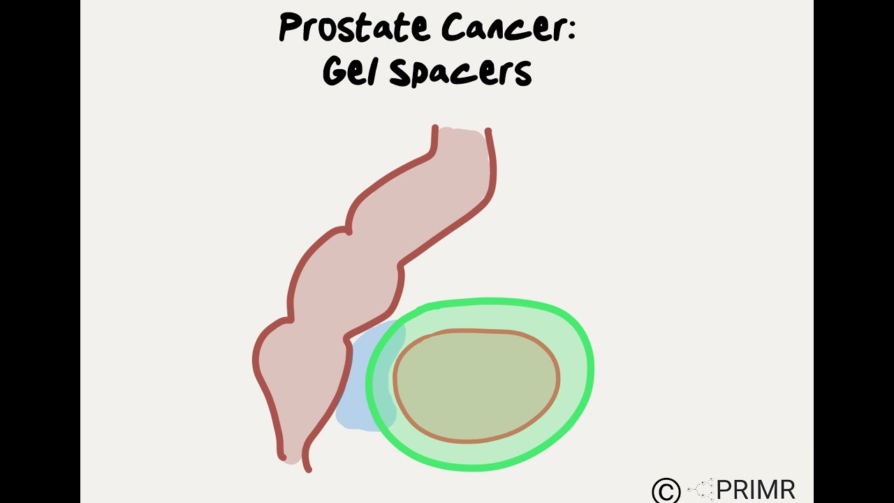 Doctor Explains Prostate Gel Spacer (SpaceOAR) - YouTube