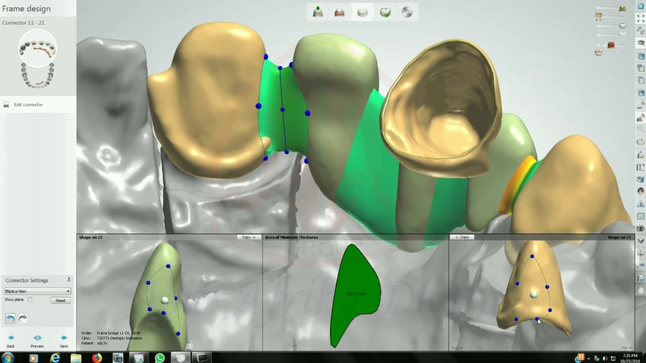 Design of PFM Coping with Artificial Gum - YouTube