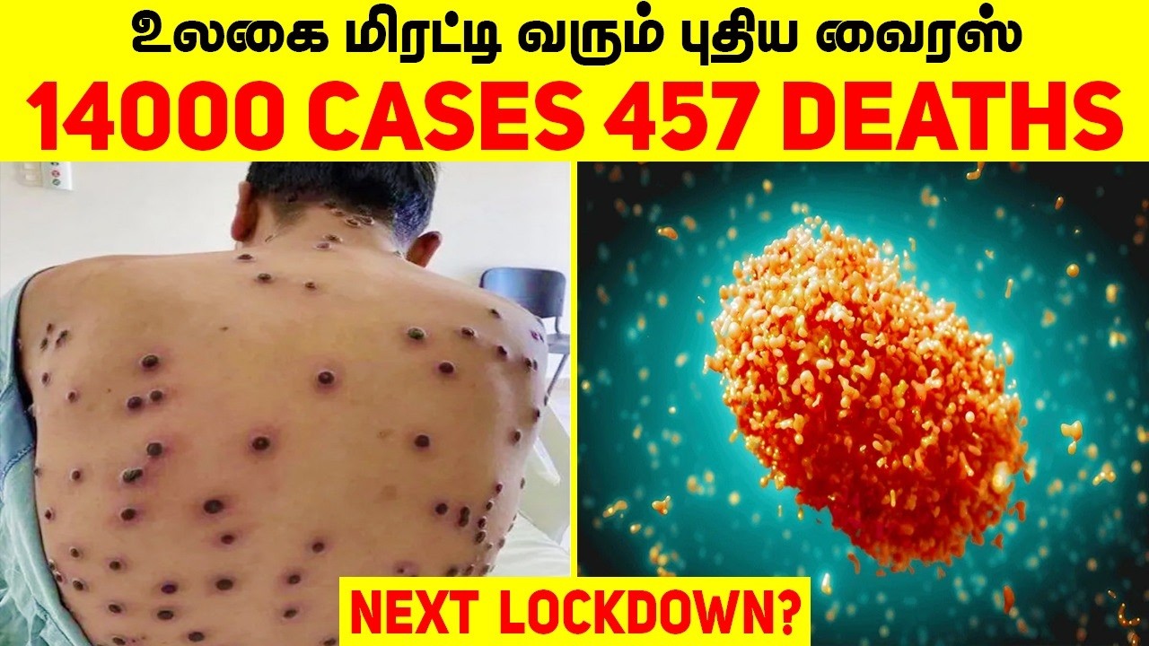 ALERT! Covidக்கு அடுத்து உலகை முடக்கபோகும் கொடூரமான வைரஸ் | M-Pox Virus ...