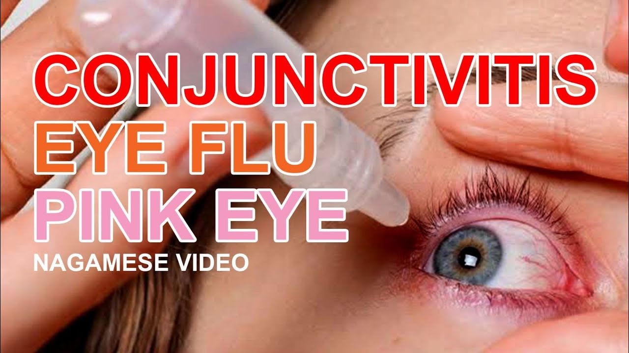 Conjunctivitis/Pink Eye/Eye Flu: Nagamese Video - YouTube