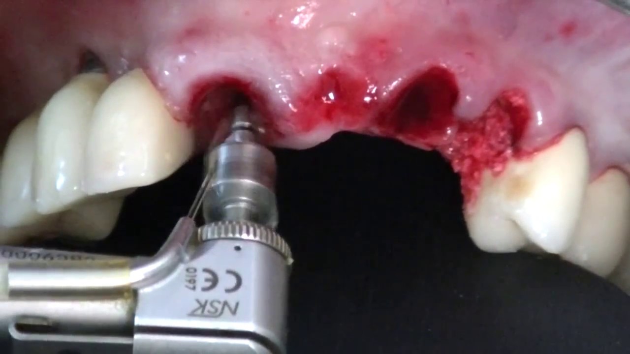 Post Extraction Implant Placement With Immediate Loading and Socket ...