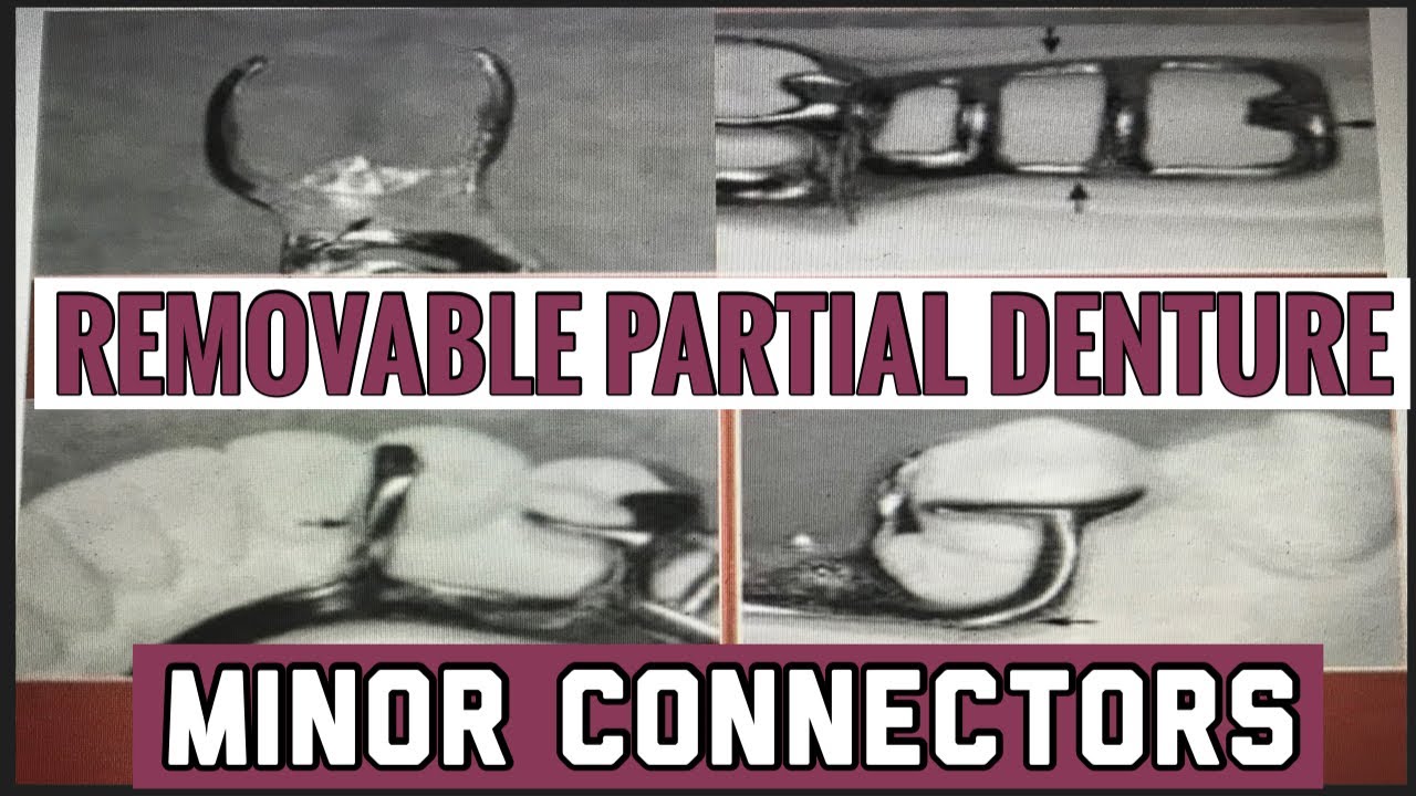 MINOR CONNECTORS IN REMOVABLE PARTIAL DENTURE II PROSTHODONTICS - YouTube