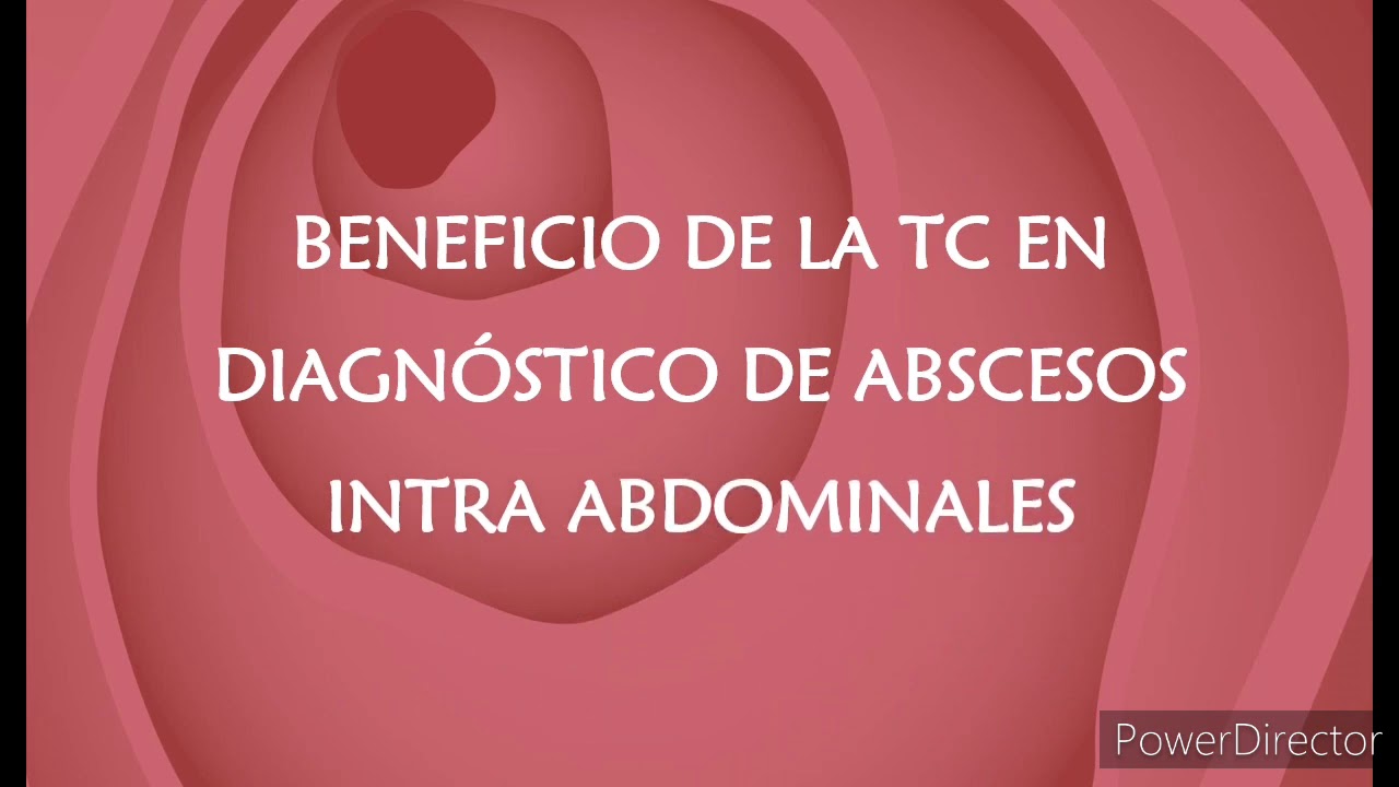Absceso Intra abdominal - YouTube