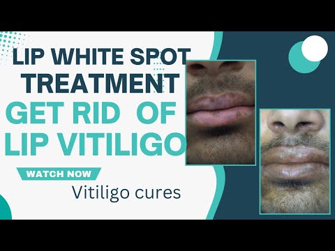 Lips White spot treatment | how to get rid of vitiligo spots | skin ...