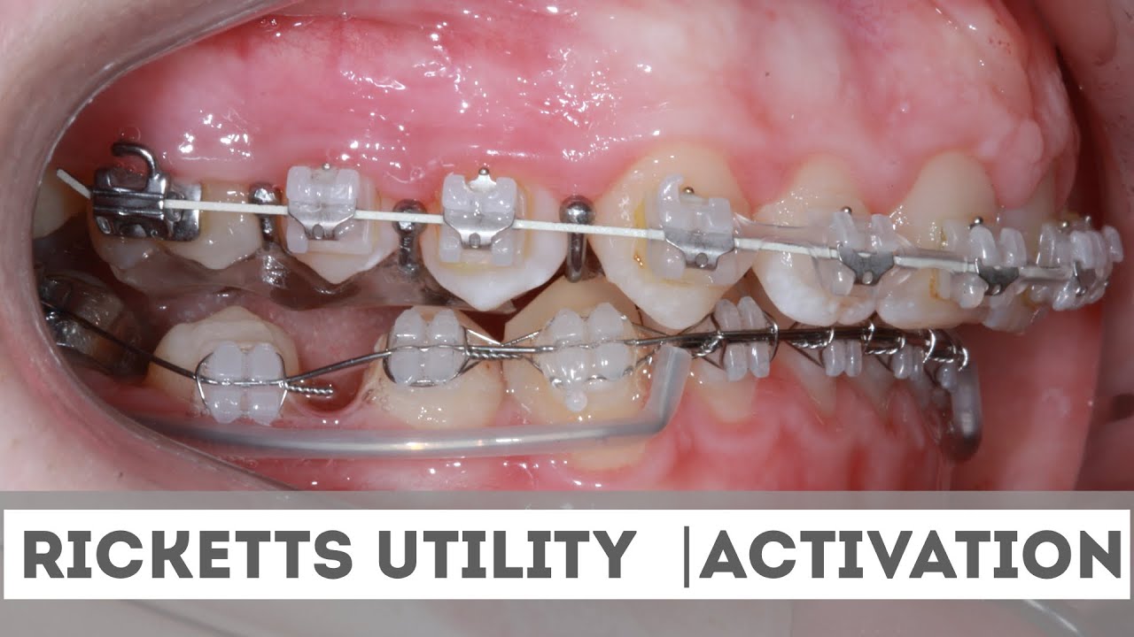 Ricketts Utility Intrusion Arch Part II YouTube ricketts-utility-intrusion-arch-part-ii-youtube