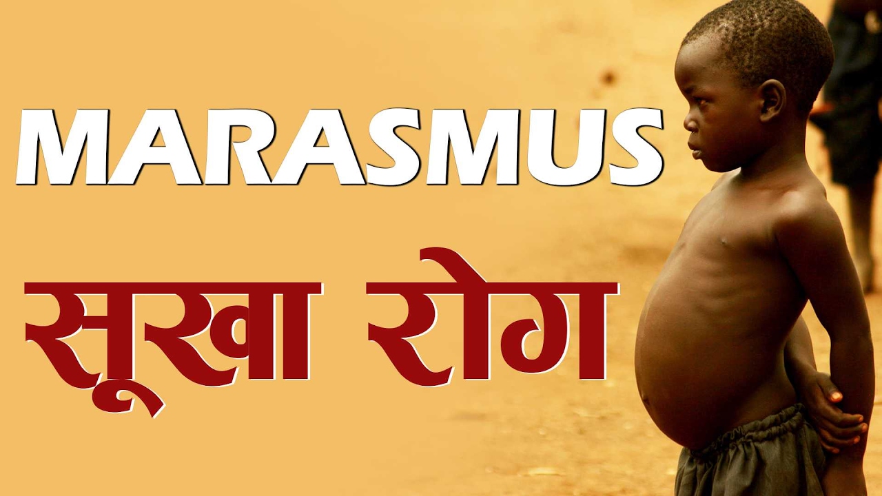 सूखा रोग | MARASMUS | MALNUTRITION | कुपोषण - YouTube