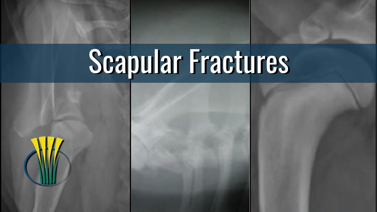 Managing fractures of the scapula in dogs and cats can be very easy ...