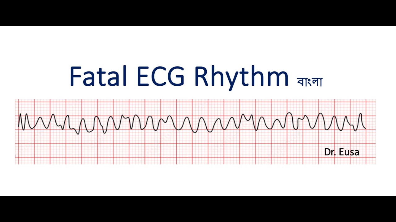 Fatal ECG Rhythm - YouTube