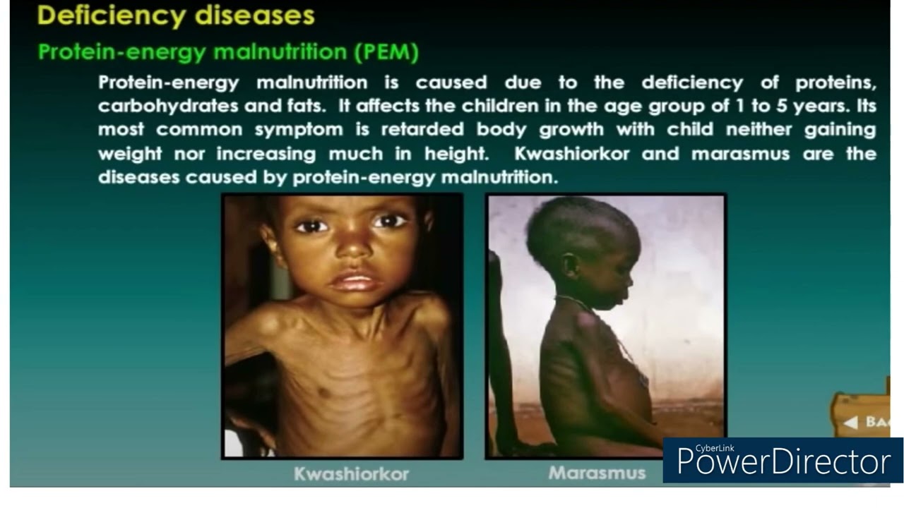 Deficiency diseases | Grade 5 | Science | Concept Video ...