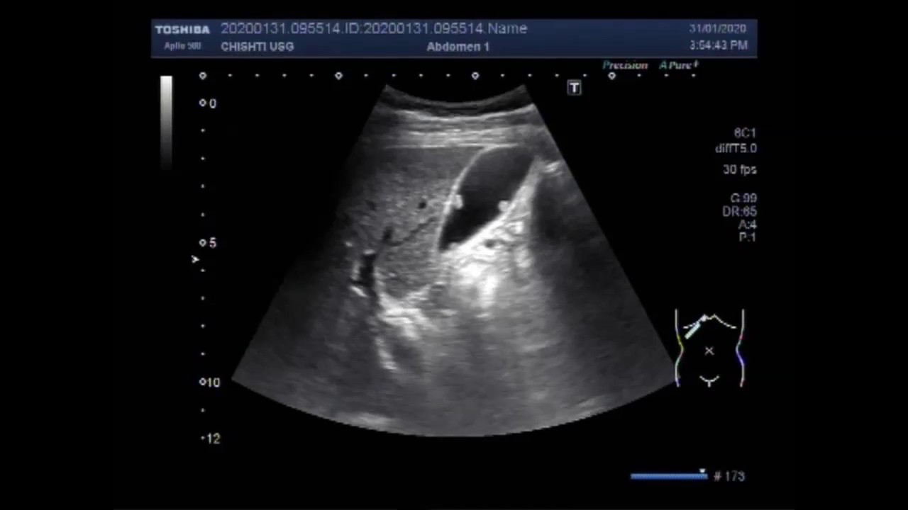 Ultrasound Video showing Gall Bladder polyps and Enlarged Prostate BPH ...