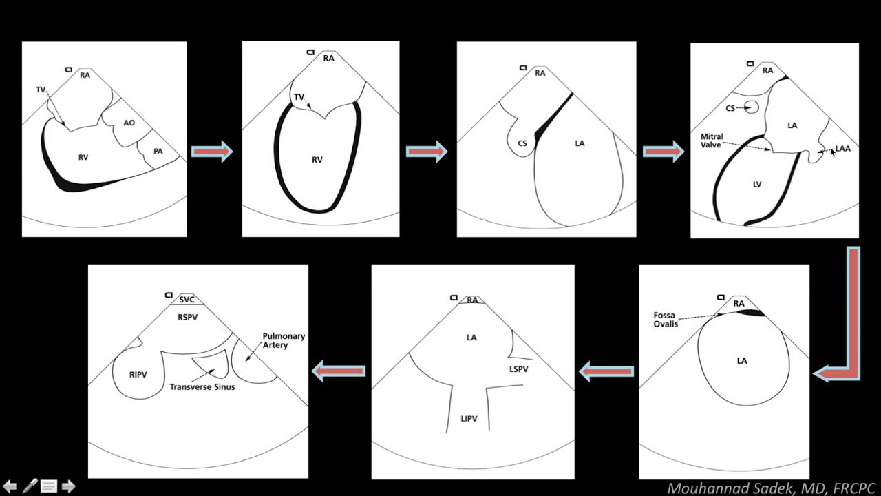 Intracardiac Echocardiography in EP Procedures - How can it help? - YouTube
