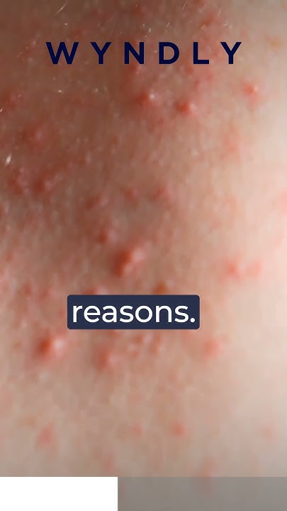Why Does Grass Make You Itchy Allergies Skinallergy Skinrashes Allergyrash Rashes Youtube