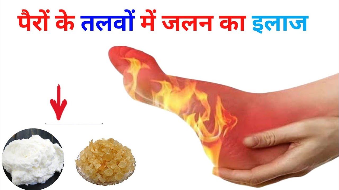 pairon ke talve mein jalan ka ilaaj || पैरों के तलवों में जलन का इलाज ...