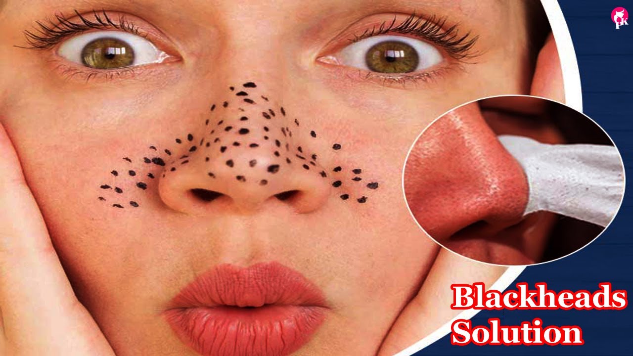 Blackheads Removing # Instant glow # Bru Face Pack# - YouTube