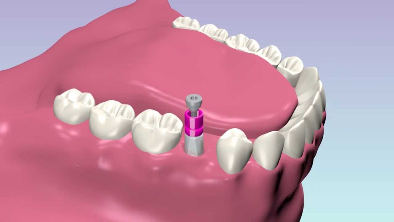 AIDI Biomedical - 3.5mm Abutment Coping for Impression - YouTube