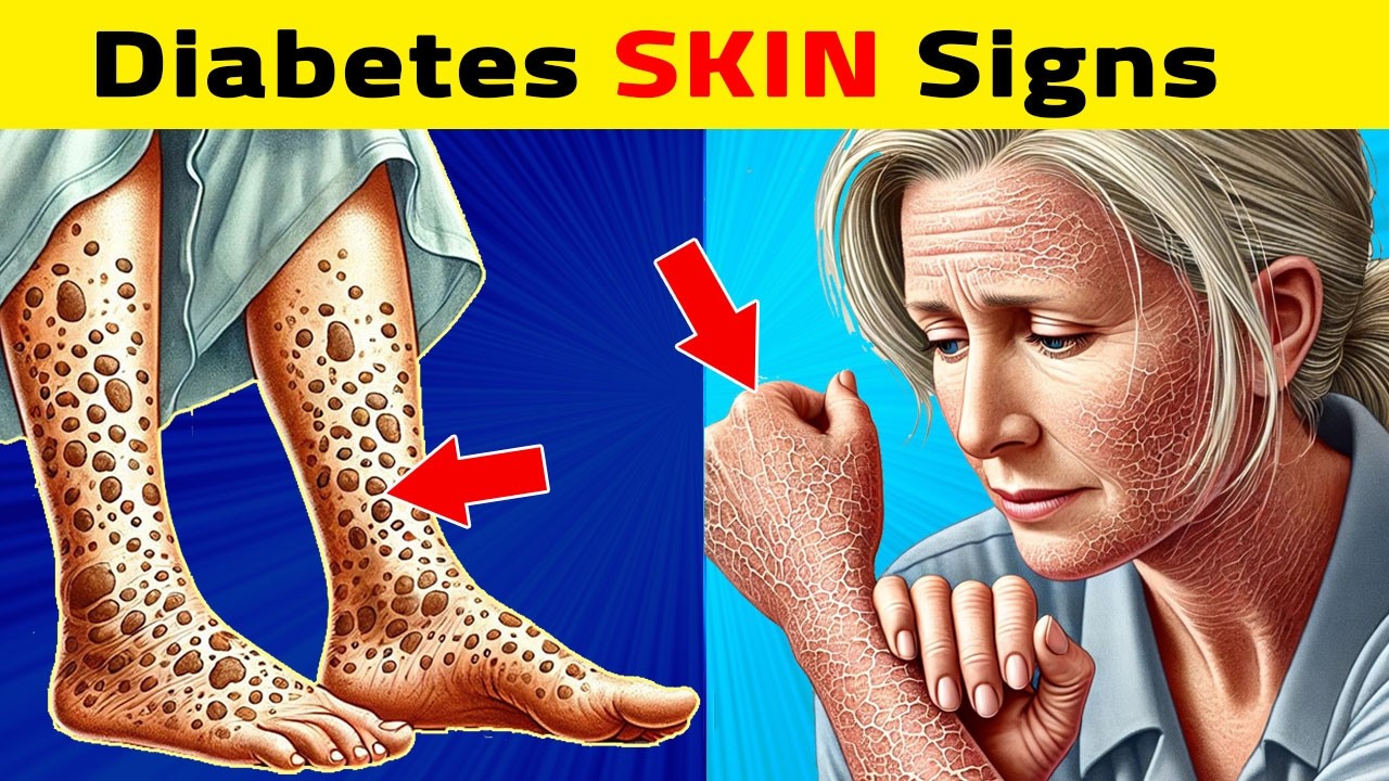 8 Diabetic Skin Signs You Shouldn't Ignore! - YouTube
