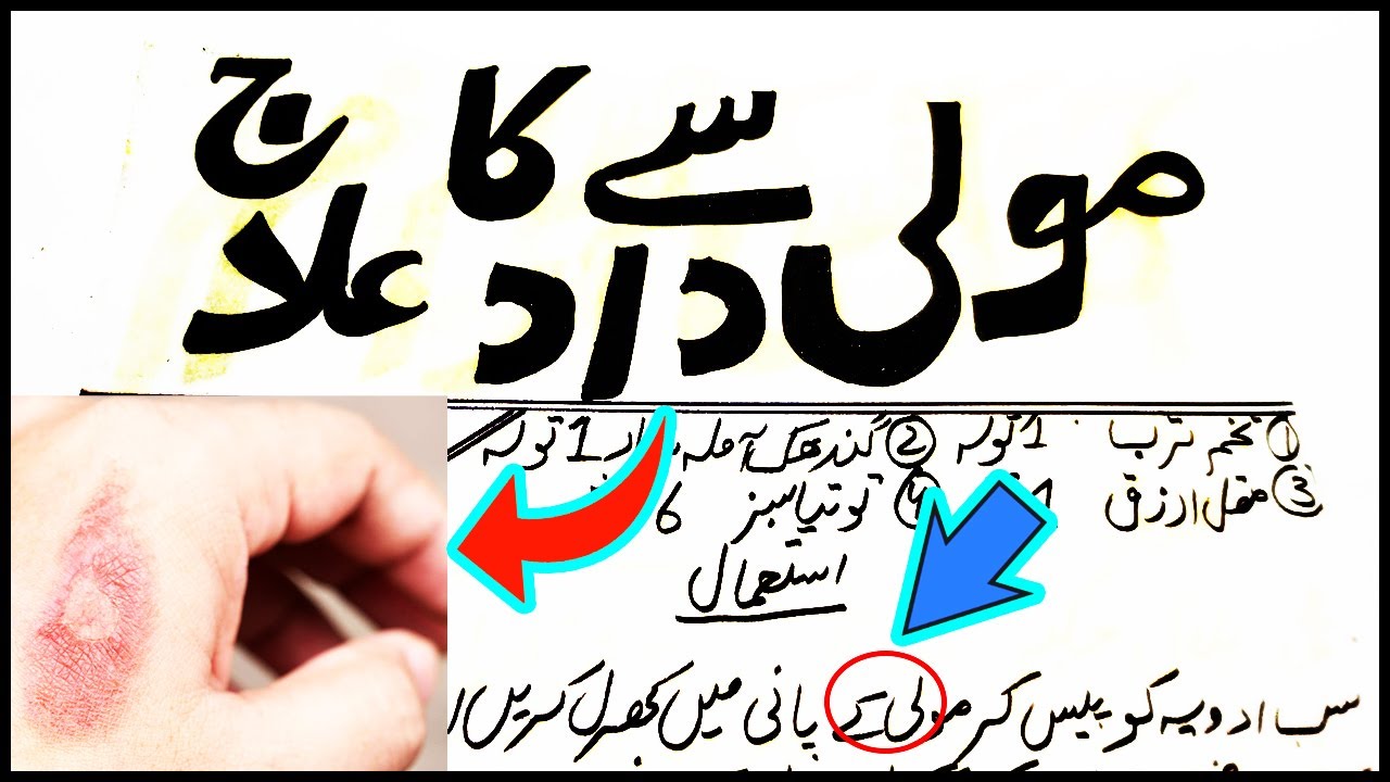 Fungal infection treatment at home Khujli ki medicine Daad ki best ...