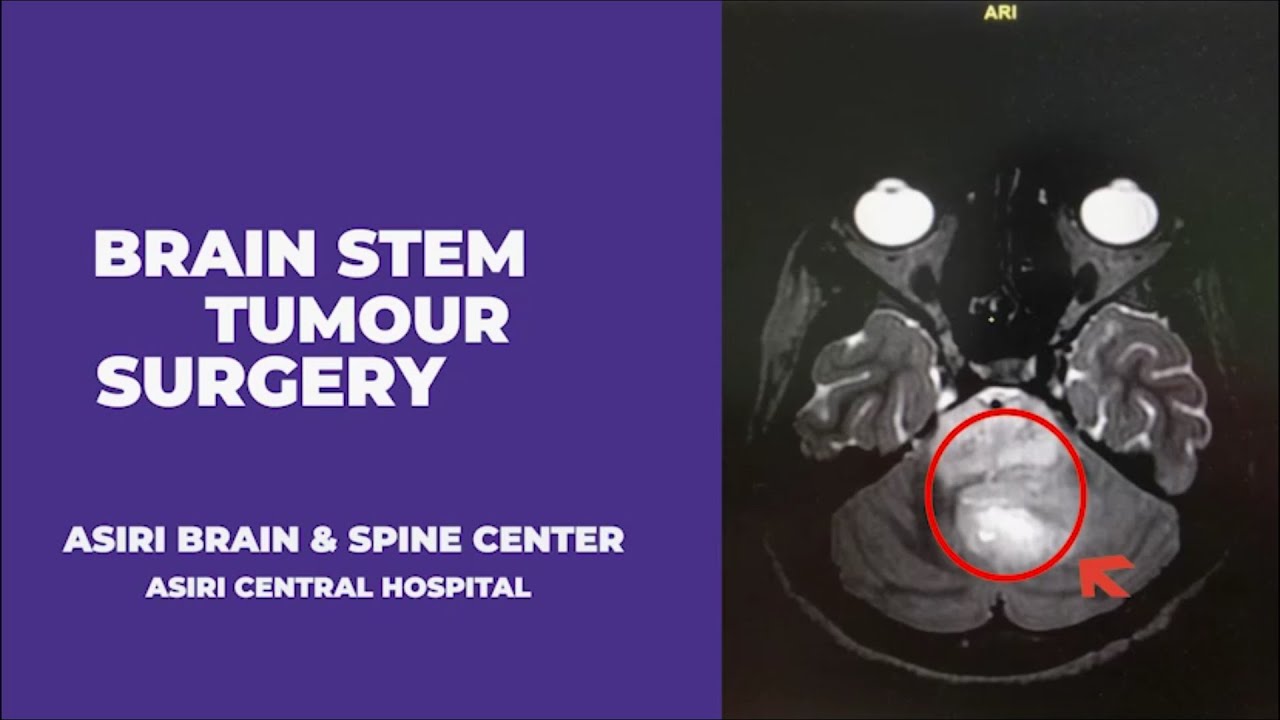 Excision Of Left Cerebllar and Brain Stem Tumour Surgery - YouTube
