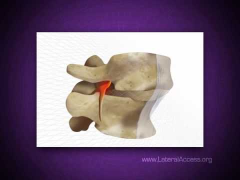 The XLIF Approach - part 3 - YouTube