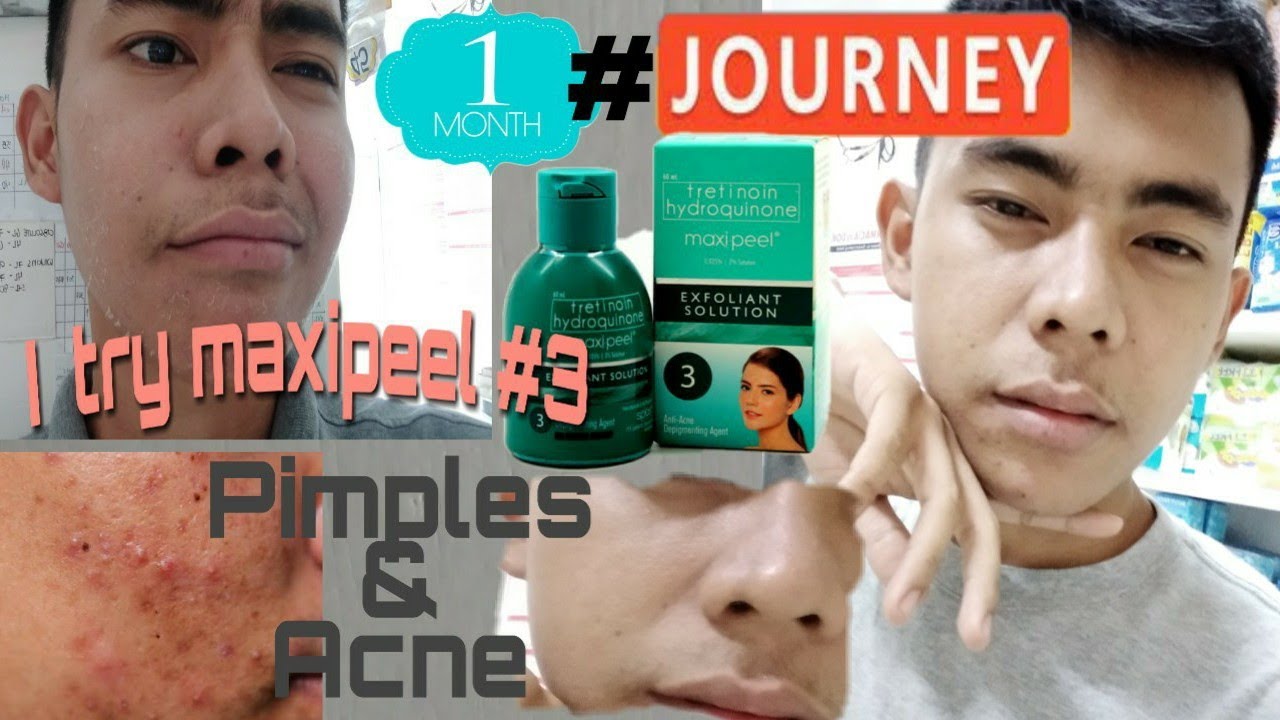 I TRY Maxipeel #3 1month journey //Exfoliating solution to Remove ...