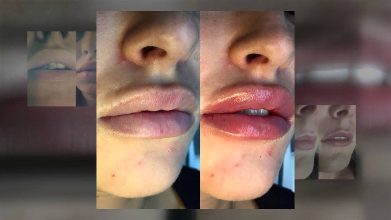Lip Injections Kent - YouTube