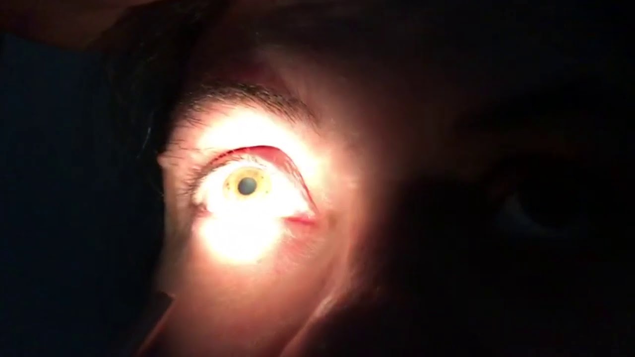 Left RAPD due to CVT - YouTube