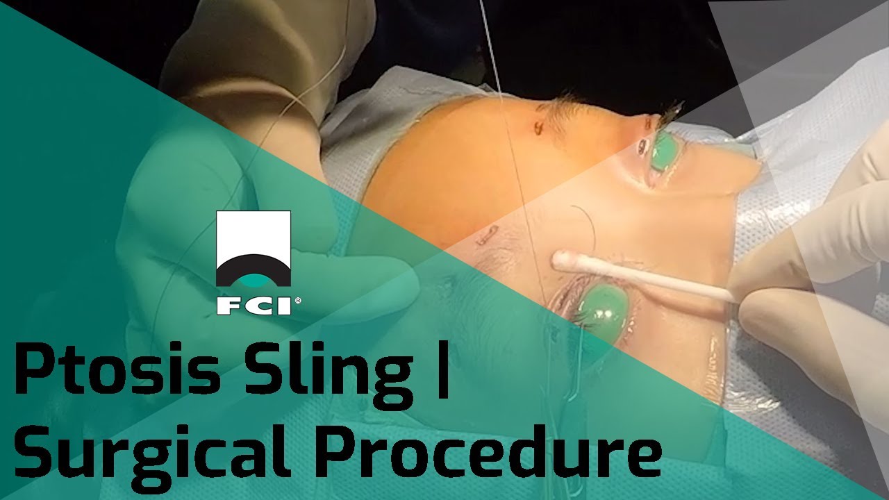 Ptosis Sling | Silicone Frontalis Suspension | Procedure | FCI Eyelids ...