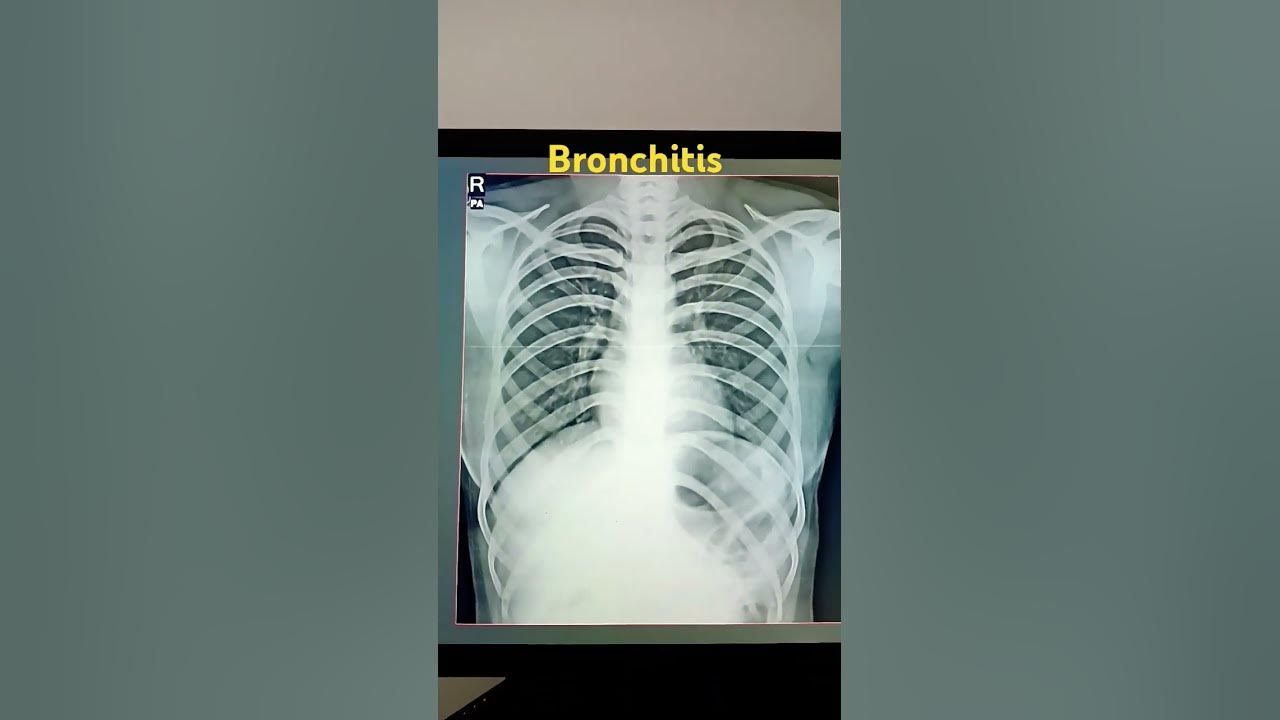Women X ray chest PA BVM Bronchitis please subscribe short video - YouTube